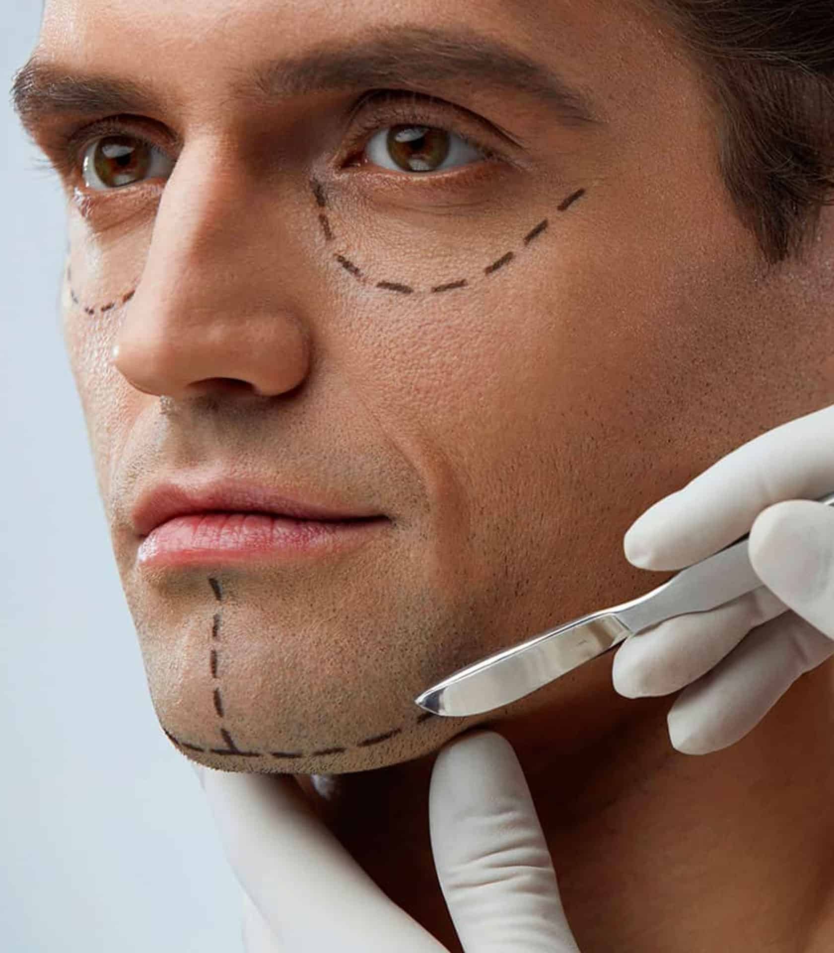 Facial Feminization Surgery - LA Beauty Guide
